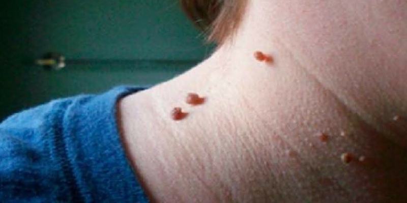 How to identify a wart: common types and treatments